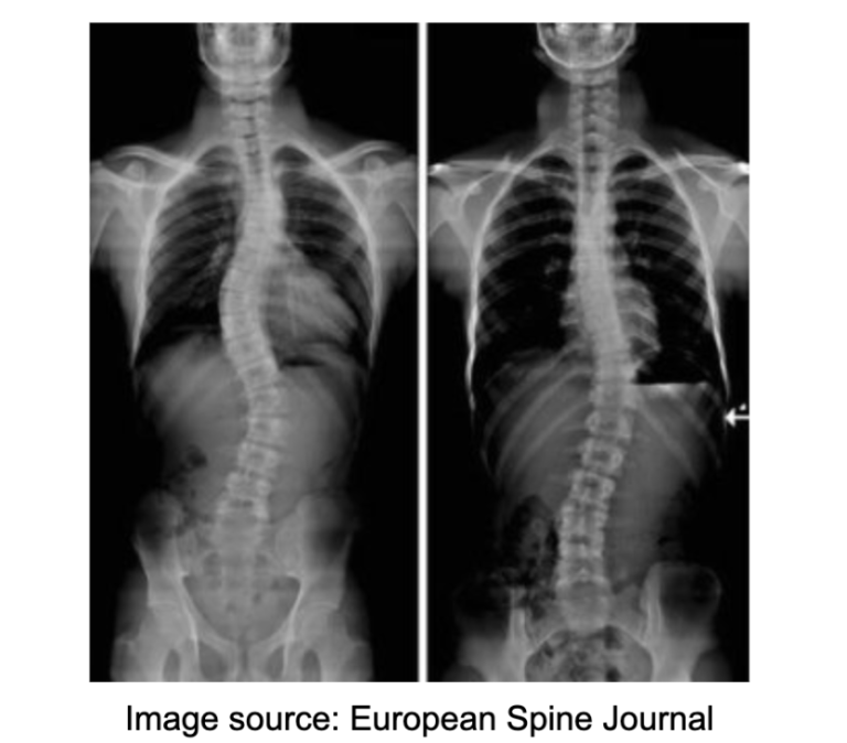 How X-rays Are Used to Diagnose Scoliosis - PhysioElements Physical Therapy